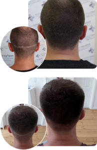Narbenpigmentierung: Perfektes Ergebnis bei den Profis | Elithair